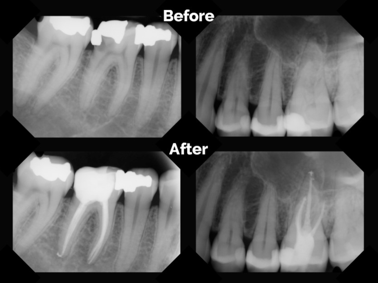 Root Canal - Clover Square Dental Clinic